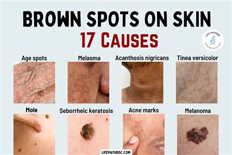Raised Brown Spots On Body