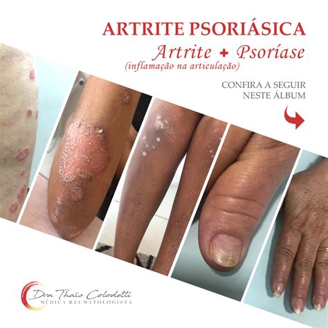 Aprender Sobre Imagem Artrite Psori Tica Fotos Br Thptnganamst Edu Vn