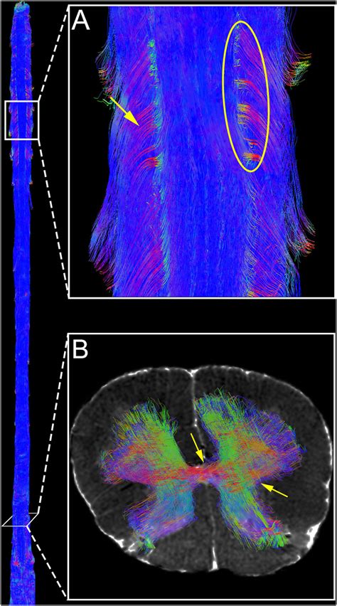 Directionally Colored Diffusion Tractography Of The Human Spinal Cord