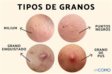 ajo táctica aleación por que salen las bolas de grasa un poco gramática