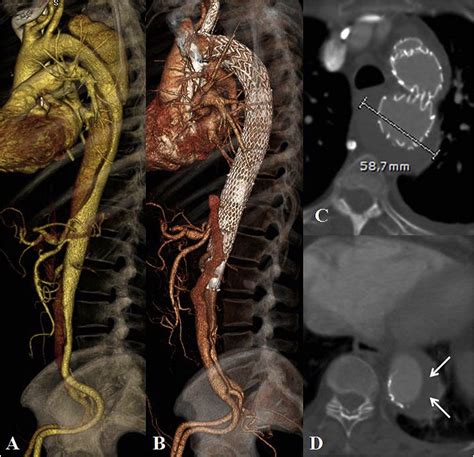 Thoracic Endovascular Aortic Repair For Type B Acute Aortic Dissection
