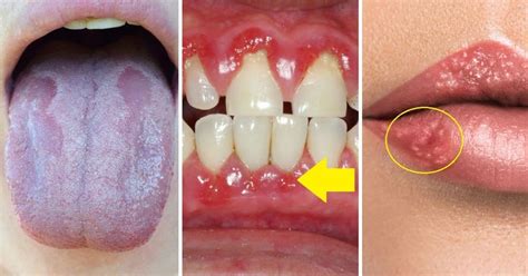 Ascensor Excelente Atravesar El Herpes Labial Es Contagioso Al Besar