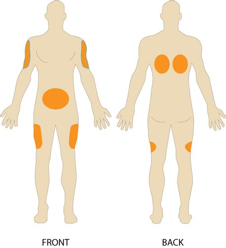 Injection Comp Flashcards Quizlet