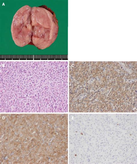 Macroscopic Findings And Pathological Features Of The Resected Tumor