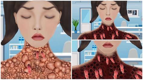 ASMR Remove Big Acne Maggot Infected Neck ASMR Animation Treatment