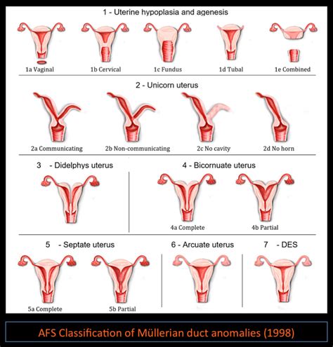 AFS Classification of Múllerian duct anomalies Download Scientific