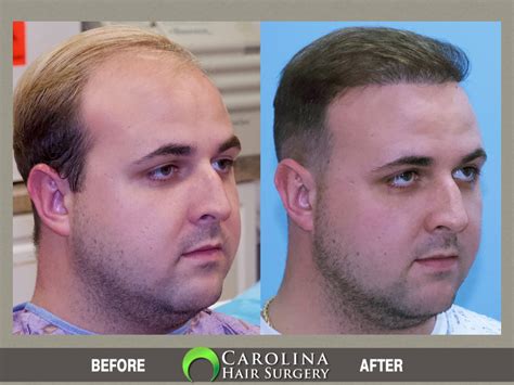 Top 100 Image 6 Month Hair Growth Thptnganamst Edu Vn