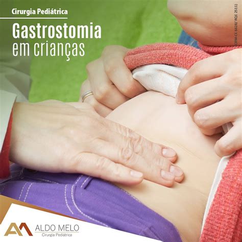 Gastrostomia em Crianças Dr Aldo Melo Cirurgia Pediátrica