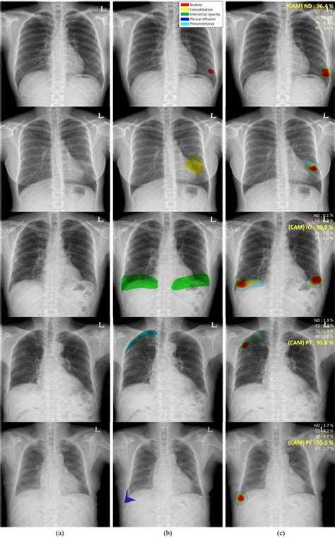 Visualization Of The Class Activation Map Cam For Five Pulmonary