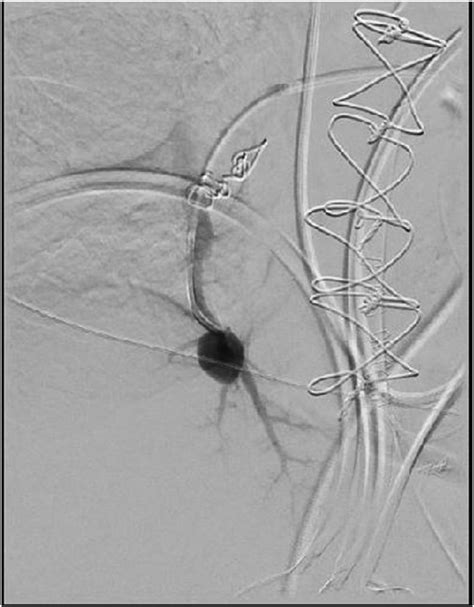 Digital Subtraction Arteriogram Dsa Prior To Embolization Reveals A
