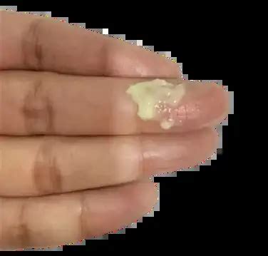 Vajinada sarı akıntı ve koku neden olur 0546 774 01 59