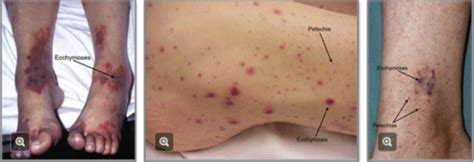 Purpura Vs Petechiae