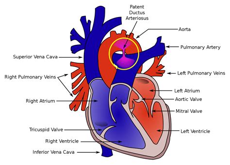 Patent Ductus Arteriosus Wikipedia