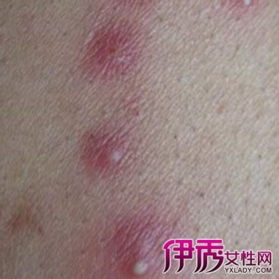 背部毛囊炎图盘点背部毛囊炎图片 介绍治疗好方法及四大注意事项 3 伊秀健康 yxlady