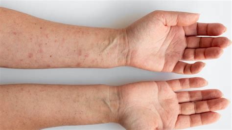 Virus de Coxsackie Cómo se contagia cuáles son sus síntomas y causas