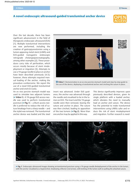 PDF A Novel Endoscopic Ultrasound Guided Transluminal Anchor Device