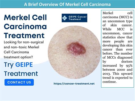 A Brief Overview Of Merkel Cell Carcinoma By GEIPE Cancer Treatment Issuu