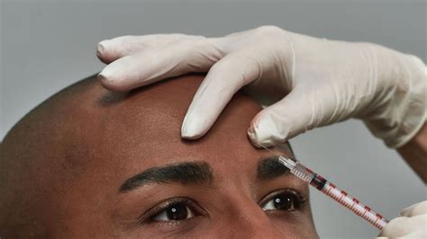 Botox no rosto antes e depois conheça os benefícios