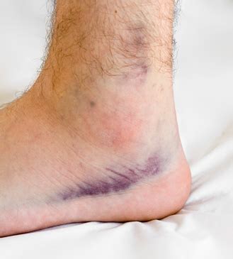 Ankle Fracture Doesnt Put The Brakes On NASCARs Keselowski Dr