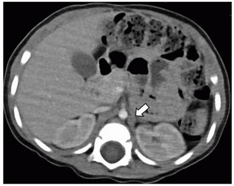 Diaphragm Radiology Key