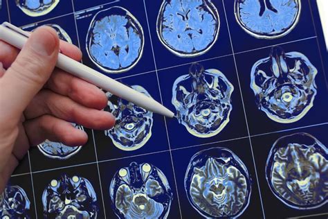 Ya Disponible Cenobamato Para Epilepsia Farmacorresistente