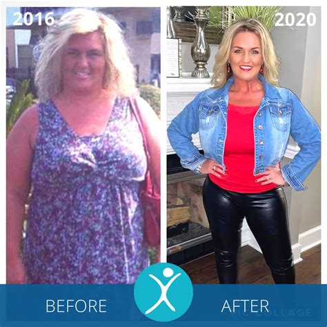 Gastric Sleeve Before And After Photos Best Of