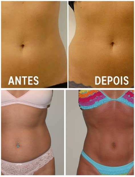 Como é Feita Lipo HD Tudo Sobre o Procedimento 2024