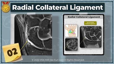 Anatomy Radial Collateral Ligament Palmar Extrinsic Ligaments