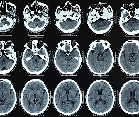 CT Vs MRI Blue Rock Medical