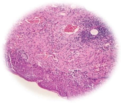 Figure From Prepubertal Female Bartholin S Gland Abscess A
