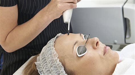 Q Switch Nd YAG Laser Derma Miracle Clinic Delhi