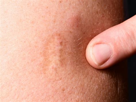 Variole Du Singe Tout Savoir Sur La Vaccination Sciences Et Avenir