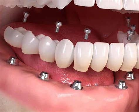 Implante Dentário Só Sorriso Odontologia Recreio do Bandeirantes