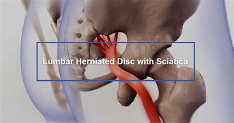 Lumbar Herniated Disc With Sciatica Dr Kevin Pauza The Discseel