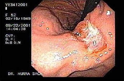 Gastroscopia Adenocarcinoma Ulcerado Ocronos Editorial Cient Fico