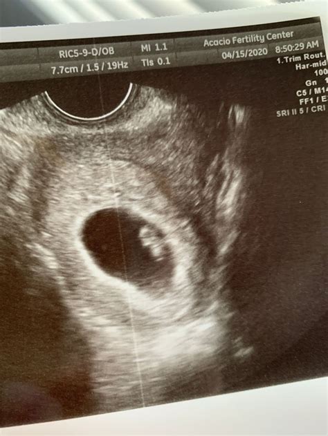 Week Ultrasound Heartbeat