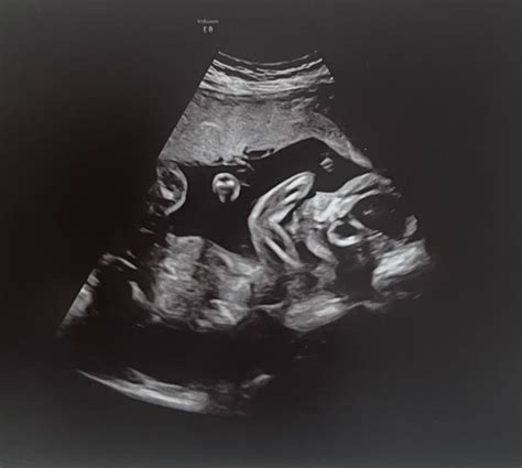 Bump Pics At Weeks Mumsnet