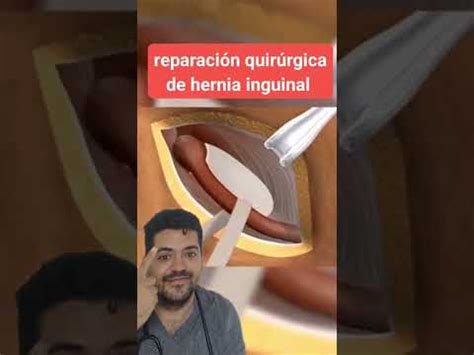 Has Sentido Un Bulto En Tu Ingle Drarmenta Suscribete