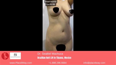 Brazilian Butt Lift In Tijuana Mexico By Dr Sealtiel Machuca