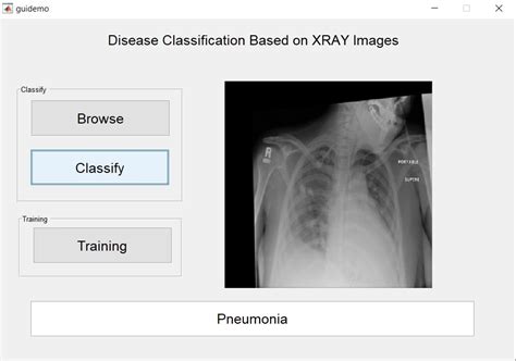 pneumonia detection in xray images using deep learning