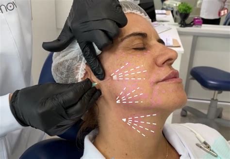 Conoces Sobre Bioestimuladores