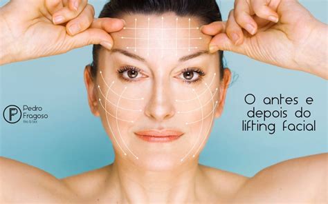 O Antes E Depois Do Lifting Facial Dr Pedro Fragoso