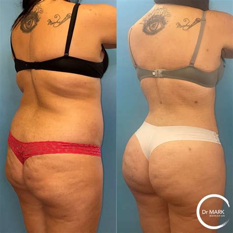 Plastic Surgery Body Results Before After Gallery Dr Mark Markarian