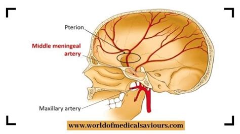 Middle Meningeal Artery Epidural Hematoma