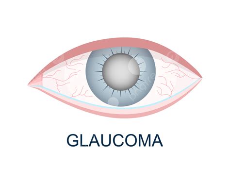 Gambar Mata Dengan Glaukoma Closeup View Ilustrasi Lensa Berair Png