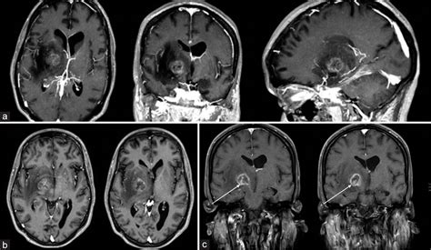Surgical Neurology International