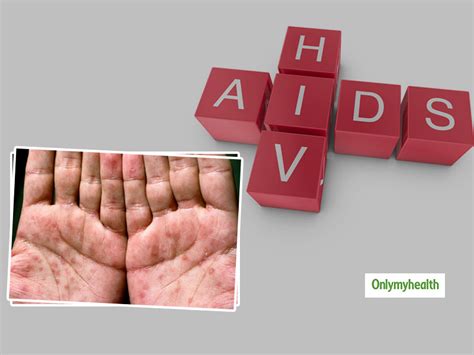 Are Rashes And Skin Conditions Associated With Hivaid