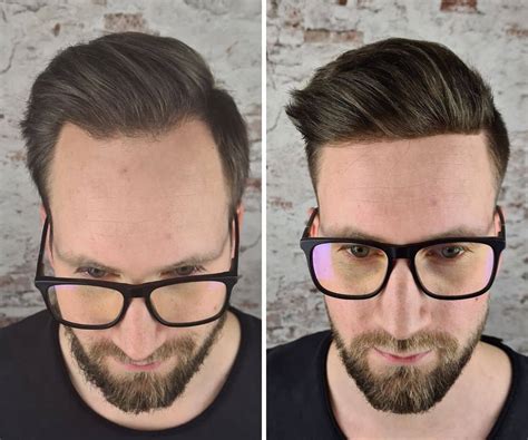 Inspiring Haircuts For Men With Receding Hairlines