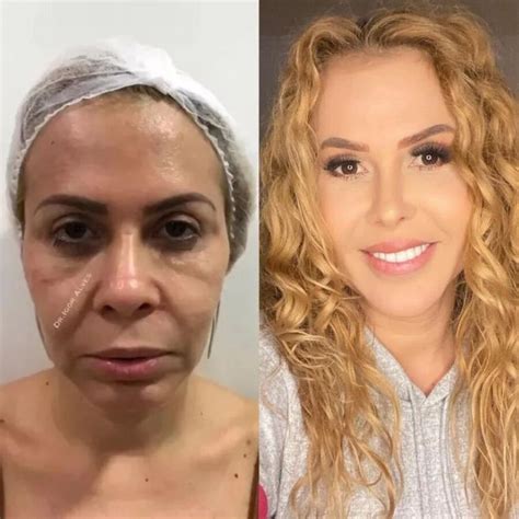 Veja o antes e depois de famosos que fizeram harmonização facial