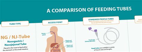 Comparison Of Different Enteral Feeding Tubes And Configurations Moog